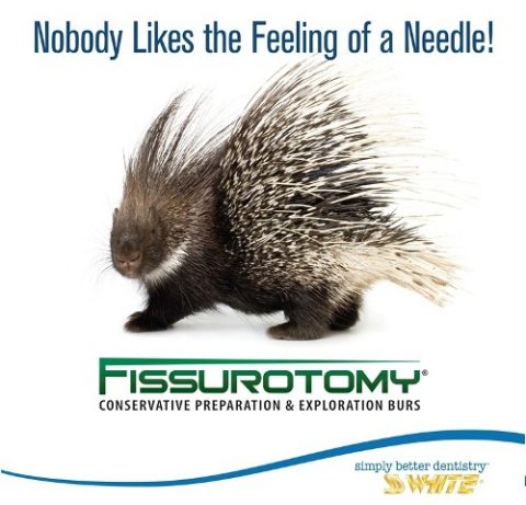Fissurotomy® | Nile Dental