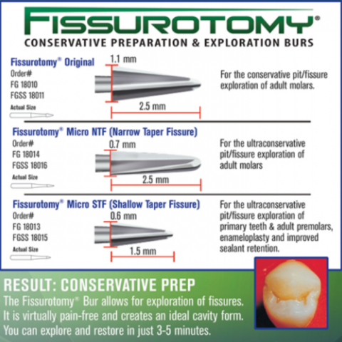 Fissurotomy® | Nile Dental